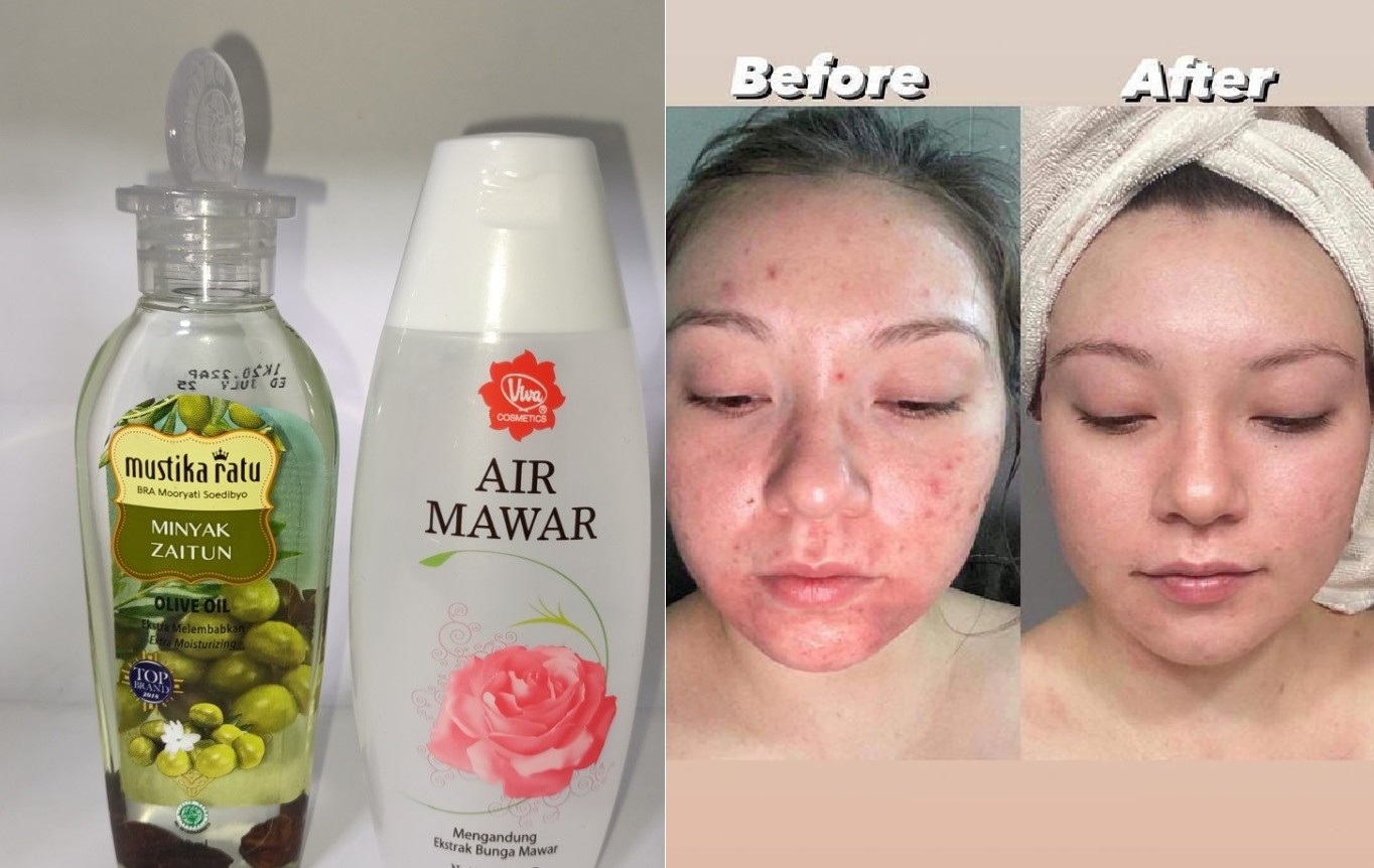 Cara Tepat Supaya Jerawat Hilang dengan Cepat Pakai Minyak Zaitun dan ...